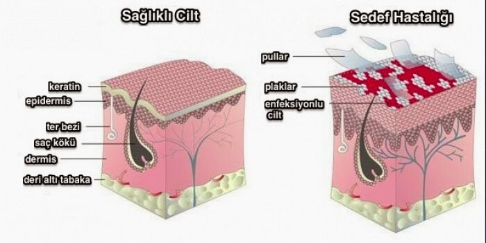 Sedef Hastalığı Nedir? Beslenme Nasıl Olmalıdır? ~ BilgiGo